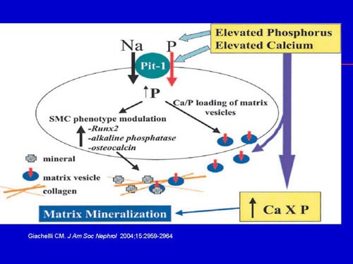 Managing Phosphorus in Chronic Kidney Disease (Slides With Transcript)