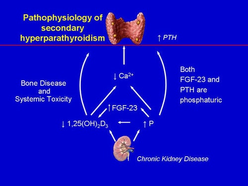 Managing Phosphorus in Chronic Kidney Disease (Slides With Transcript)