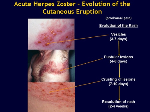 Understanding Herpes Zoster and the Herpes Zoster Vaccine (Slides With ...