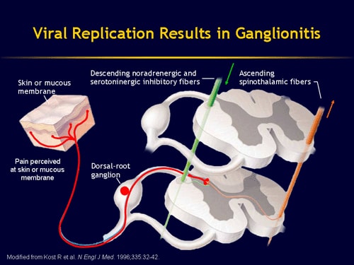 Understanding Herpes Zoster and the Herpes Zoster Vaccine (Slides With ...