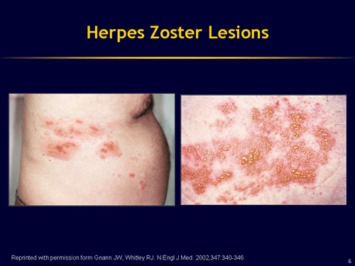 Understanding Herpes Zoster and the Herpes Zoster Vaccine (Slides With ...