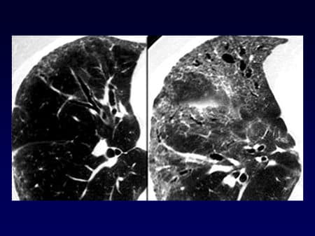 Early Diagnosis and Critical Risk Assessment in SSc-related Lung ...