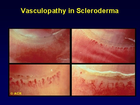 Vasculopathies in Scleroderma: Basic Science Update and Clinical ...