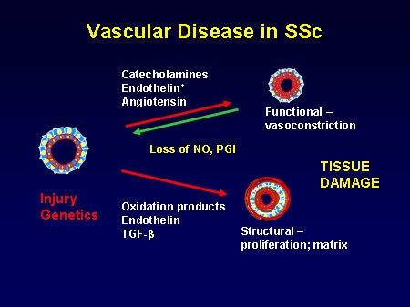 Vasculopathies in Scleroderma: Basic Science Update and Clinical ...