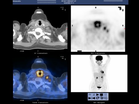 NCCN Task Force Report: PET/CT Imaging (Slides With Transcript)