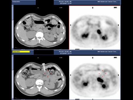 NCCN Task Force Report: PET/CT Imaging (Slides With Transcript)