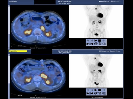 NCCN Task Force Report: PET/CT Imaging (Slides With Transcript)