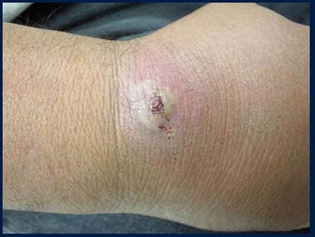 Managing the Complicated Skin and Soft Tissue Infection