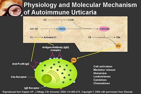 CSI for CIU (Chronic Idiopathic Urticaria): Uncovering a Patho of ...