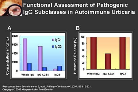CSI for CIU (Chronic Idiopathic Urticaria): Uncovering a Patho of ...