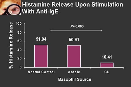 CSI for CIU (Chronic Idiopathic Urticaria): Uncovering a Patho of ...