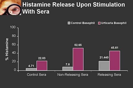 CSI for CIU (Chronic Idiopathic Urticaria): Uncovering a Patho of ...