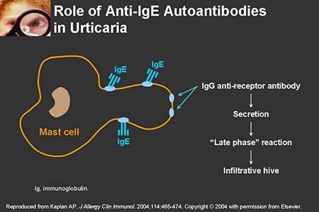 CSI for CIU (Chronic Idiopathic Urticaria): Uncovering a Patho of ...