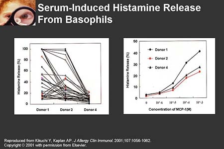 CSI for CIU (Chronic Idiopathic Urticaria): Uncovering a Patho of ...