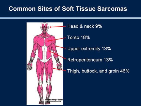 Stay Connected: Update on the Management of Sarcoma (Slides With Transcript)