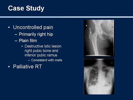 Stay Connected: Update on the Management of Sarcoma (Slides With Transcript)