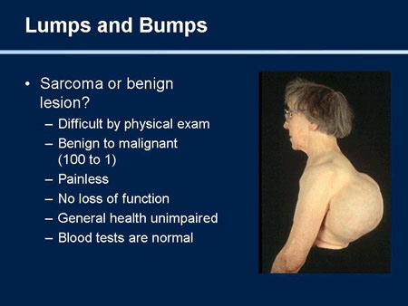 Stay Connected: Update on the Management of Sarcoma (Slides With Transcript)