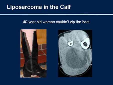 Stay Connected: Update on the Management of Sarcoma (Slides With ...