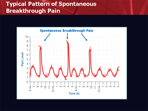 Treatment Landscape for Breakthrough Pain, Cancer (Slides With Transcript)