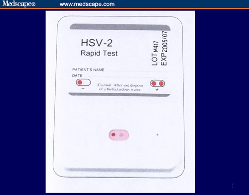 Genital Herpes and Pregnancy: Prevention and Management Strategies for ...