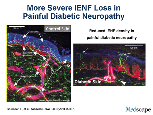 The Evolution of the Diagnosis and Management of Painful Diabetic ...