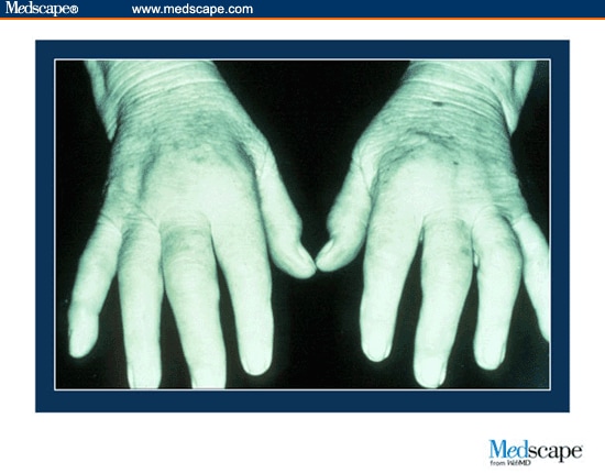 Biologics: Targeting the Mechanics of Rheumatoid Arthritis