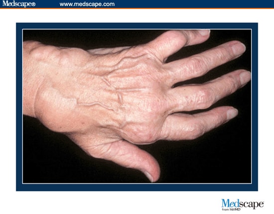 Biologics: Targeting the Mechanics of Rheumatoid Arthritis