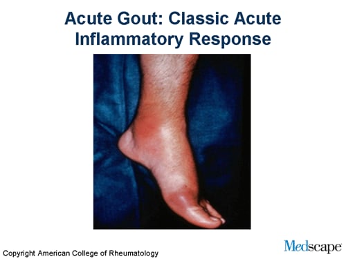 Treating Chronic Gout: The Challenges of Lowering Serum Urate Levels