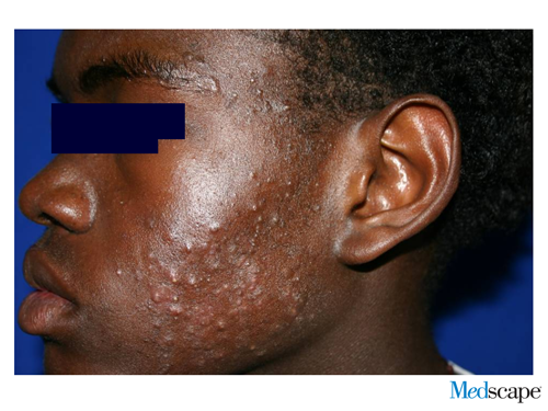 Safety of Long-term Oral Antibiotics in the Treatment of Acne (Slides ...