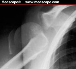 Evaluation and Classification of Proximal Humeral Fractures