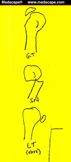 Evaluation and Classification of Proximal Humeral Fractures