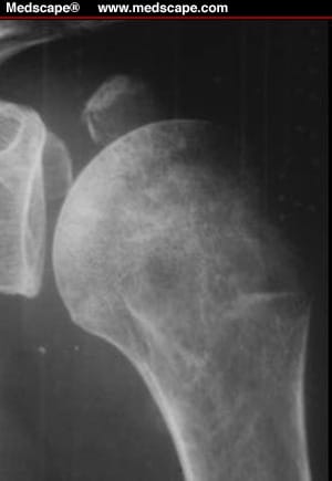 Evaluation and Classification of Proximal Humeral Fractures