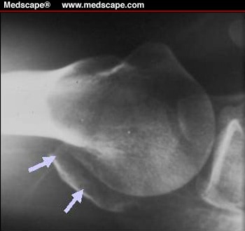 Evaluation and Classification of Proximal Humeral Fractures