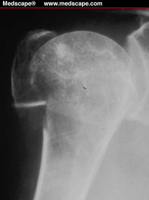 Evaluation and Classification of Proximal Humeral Fractures