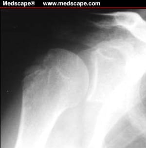 Evaluation and Classification of Proximal Humeral Fractures