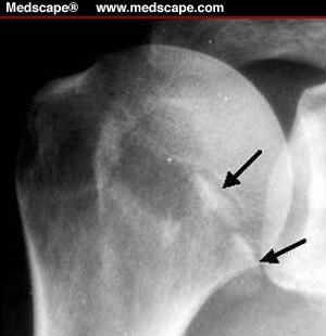 Evaluation and Classification of Proximal Humeral Fractures