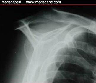 Evaluation and Classification of Proximal Humeral Fractures