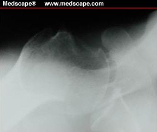 Evaluation and Classification of Proximal Humeral Fractures