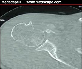 Evaluation and Classification of Proximal Humeral Fractures