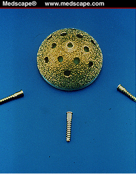Primary Cementless Acetabular Reconstruction