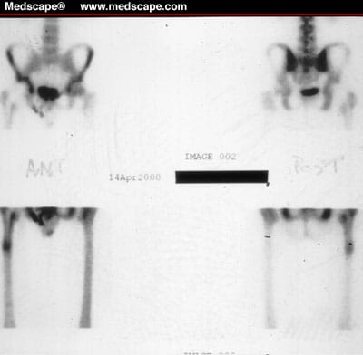 The Effects of Osteolysis and Aseptic Loosening