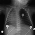 Chest Radiograph Showing Hyperexpanded Left Lung and Mediastinal Shift