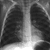 Abnormal Density at Left Lung Base