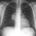 Chest Radiograph Showing Right Hilar Mass