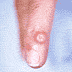 Bluish, Tender Nodule on the Finger