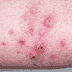 Pruritic Purple Papules