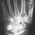 Trapezial Resection Arthroplasty for Osteoarthritis - Page 5