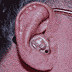 White Papules on the Ear