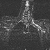 Deltoid Muscle Atrophy
