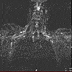 Deltoid Muscle Atrophy